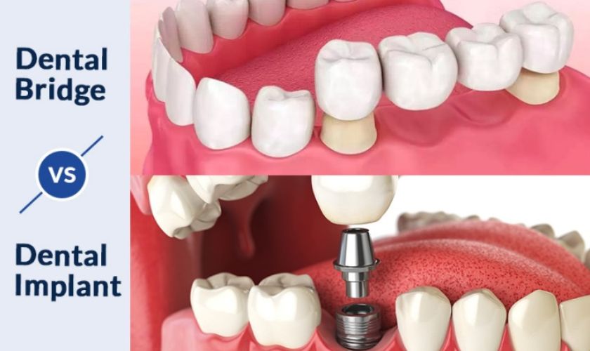 Dental Implant Vs. Bridge: Which Should You Get?
